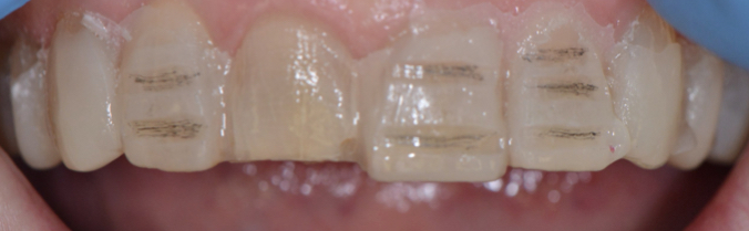 Dental News - Digital face-bow transfer technique dentofacial analyser ...