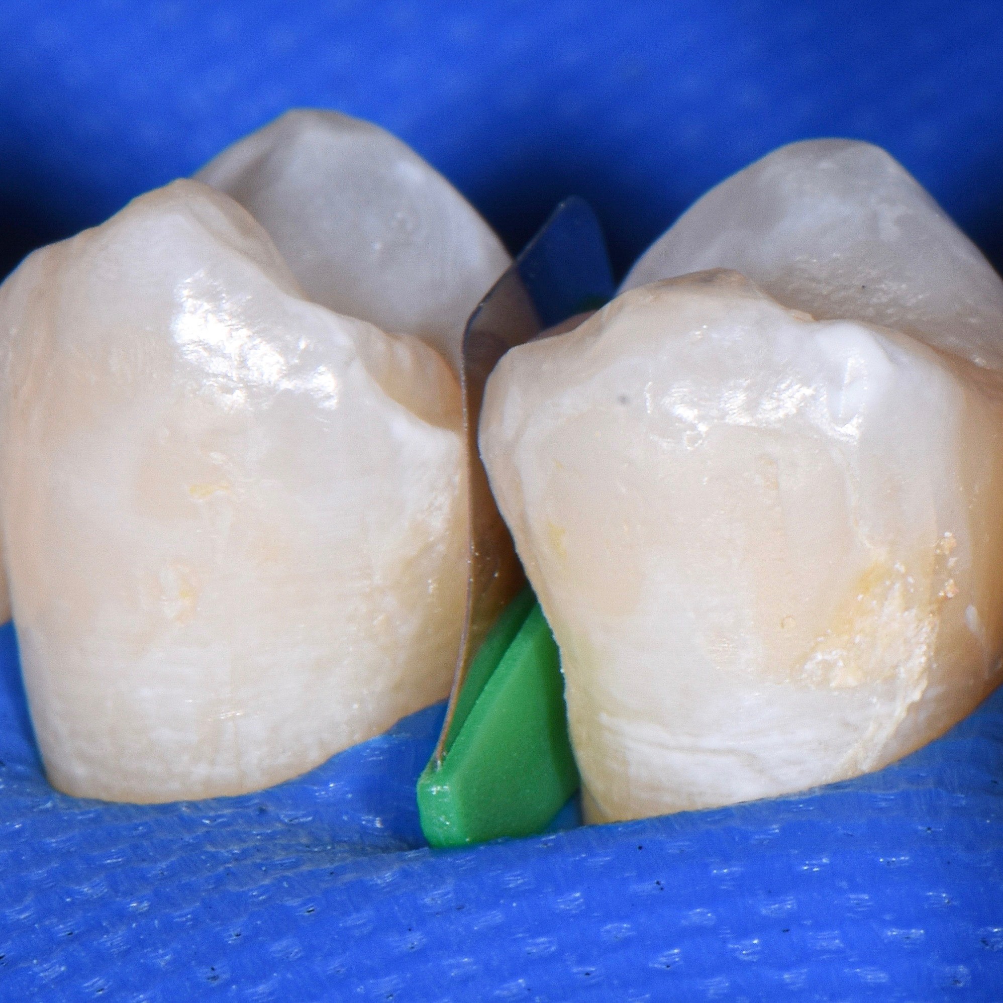 Clinical Case with FenderMate & FenderWedge by Dr. Alessandro Colella ...