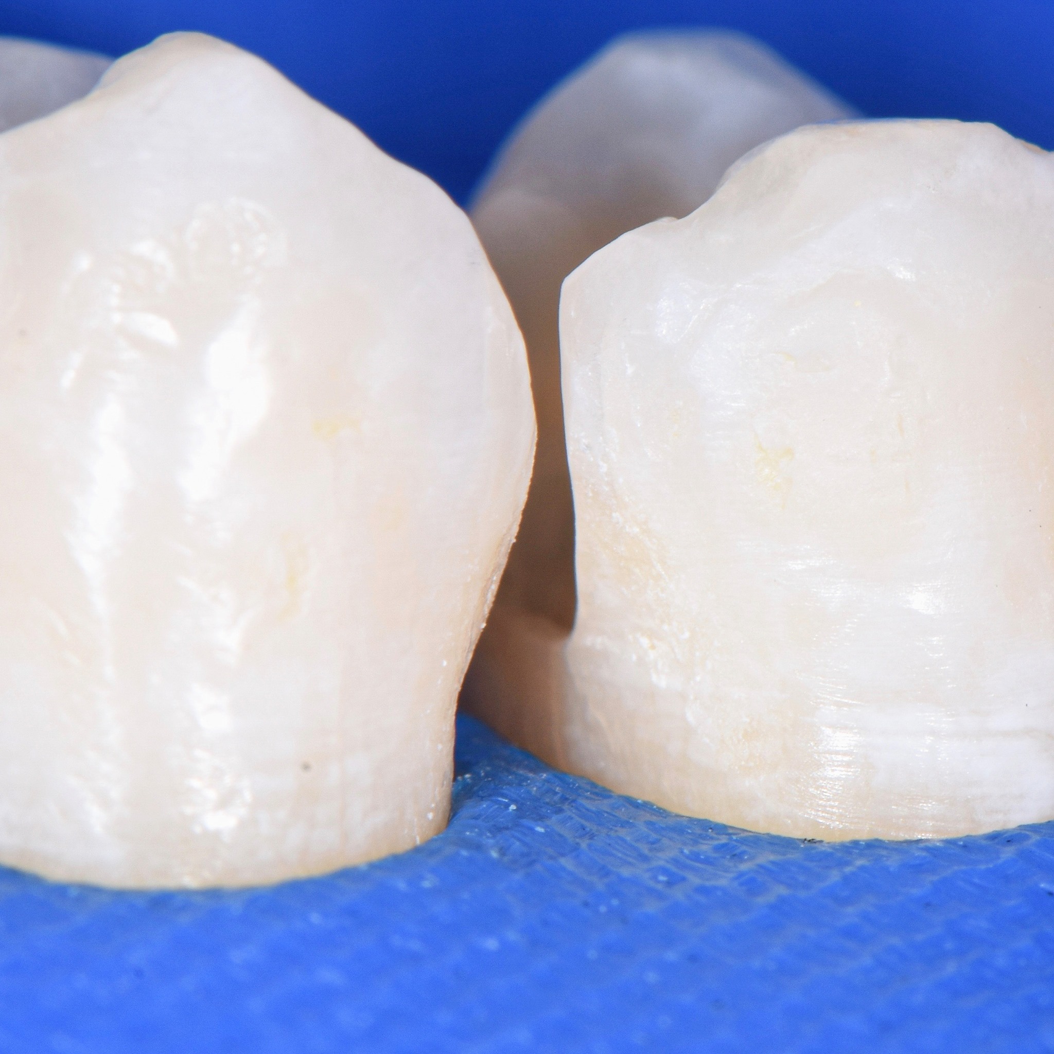 Clinical Case with FenderMate & FenderWedge by Dr. Alessandro Colella ...