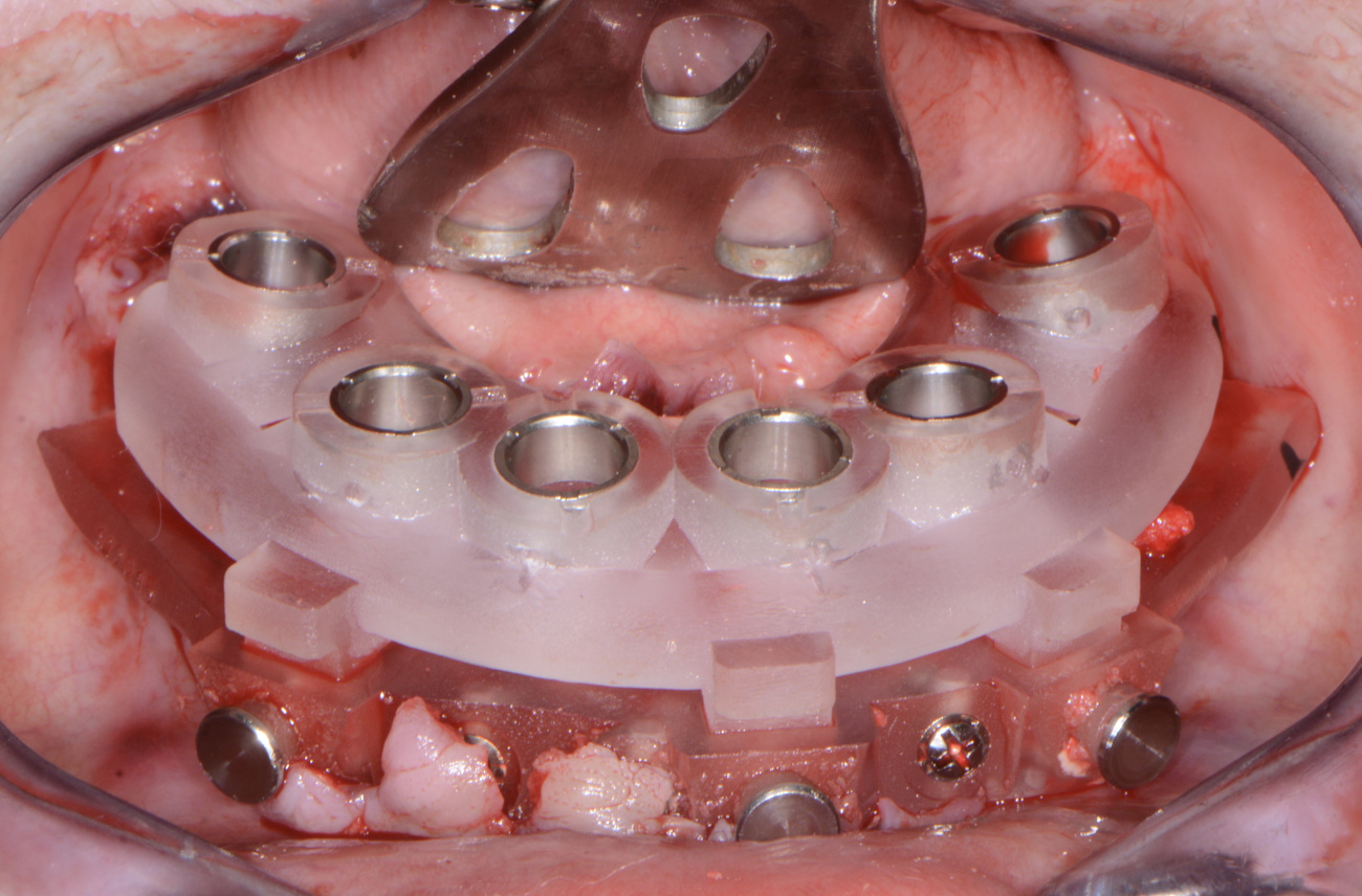 Predictable immediate guided implant placement and provisionalisation
