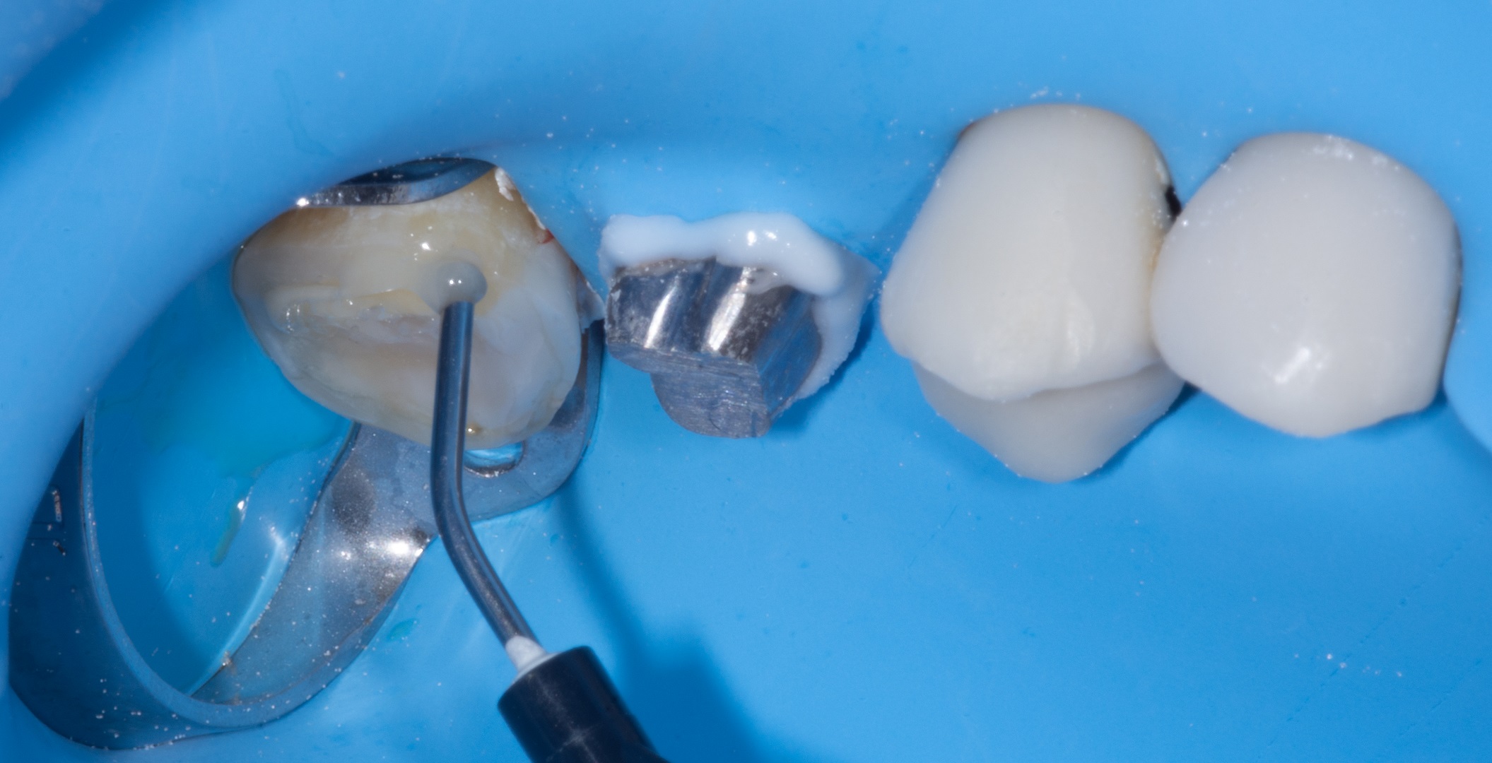 Advancements in adhesive dentistry: A case report